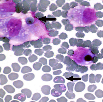 babesiosis